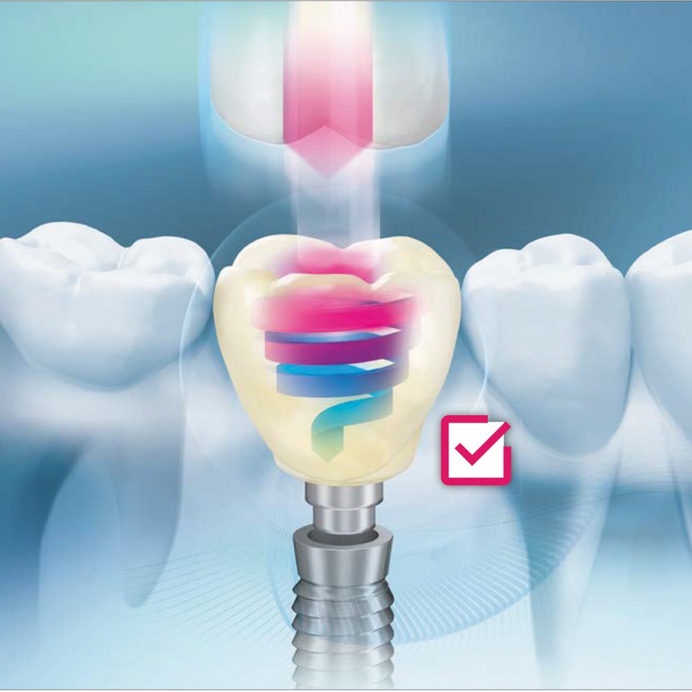 Minimally invasive inlay restoration from the hybrid ceramic VITA ...
